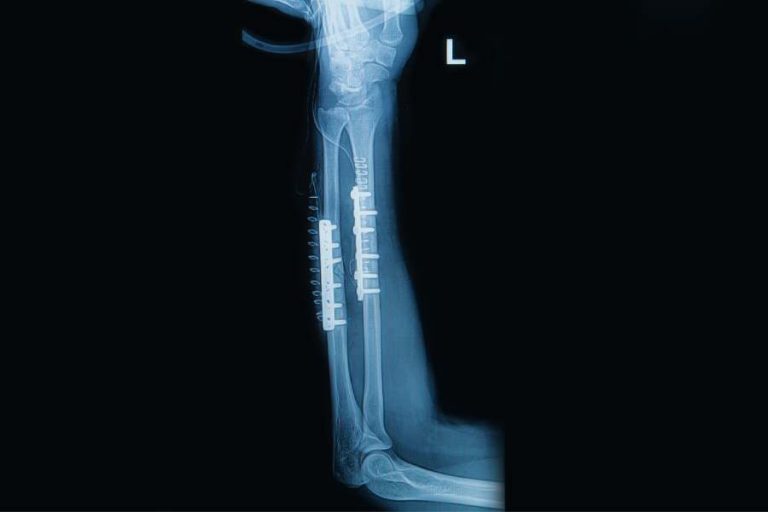 Fracturas de cúbito y radio, información sobre ambas